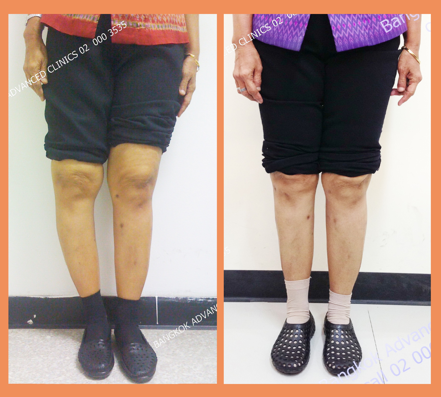 Knee & Leg Shape Correction Center - Bangkok Advanced Clinics