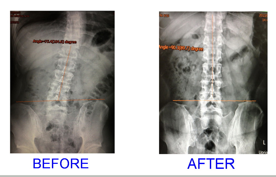 Spine and Joint Center - Bangkok Advanced Clinics