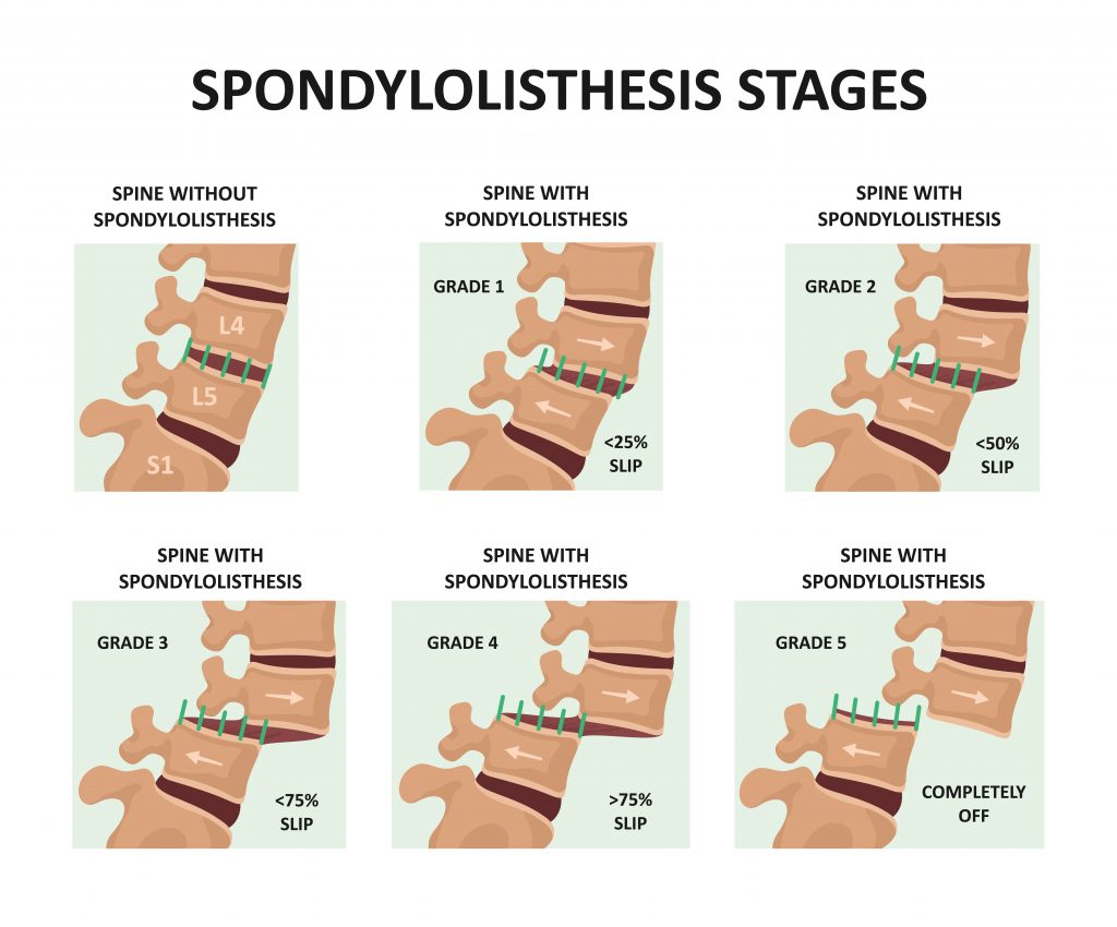 Scoliosis Causes Symptoms Treatment Bangkok Advanced Clinics