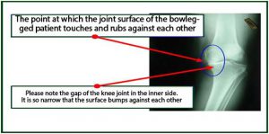 The Drawback of having bowlegs : Part 1 - Bangkok Advanced Clinics