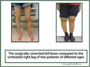 Types of Bowlegs and Operation Methods to Cure : Part 4 - Bangkok ...