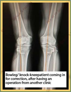 The operation to correct bowlegs, knock-knees : Part 5 - Bangkok ...