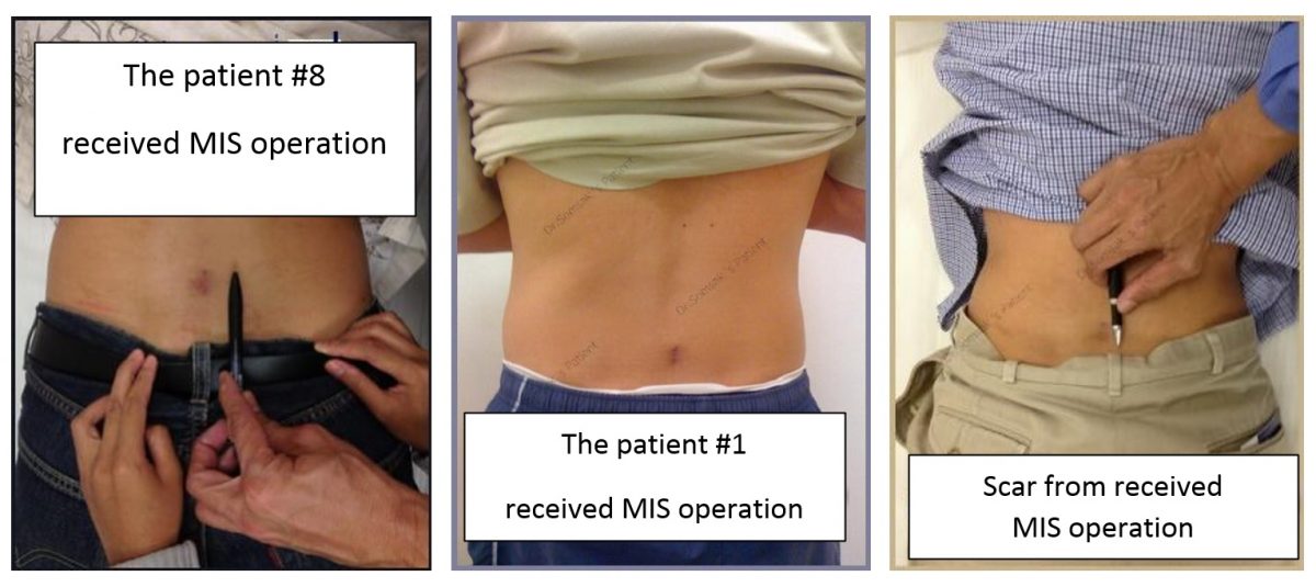 PROLAPSE DISC AND MINI - DISECTOMY - Bangkok Advanced Clinics